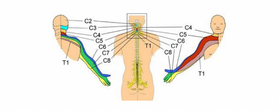 Cervicobrachialgia or radiated cervical pain, how does it affect ...
