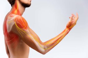 Cervicobrachialgia or radiated cervical pain, how does it affect ...