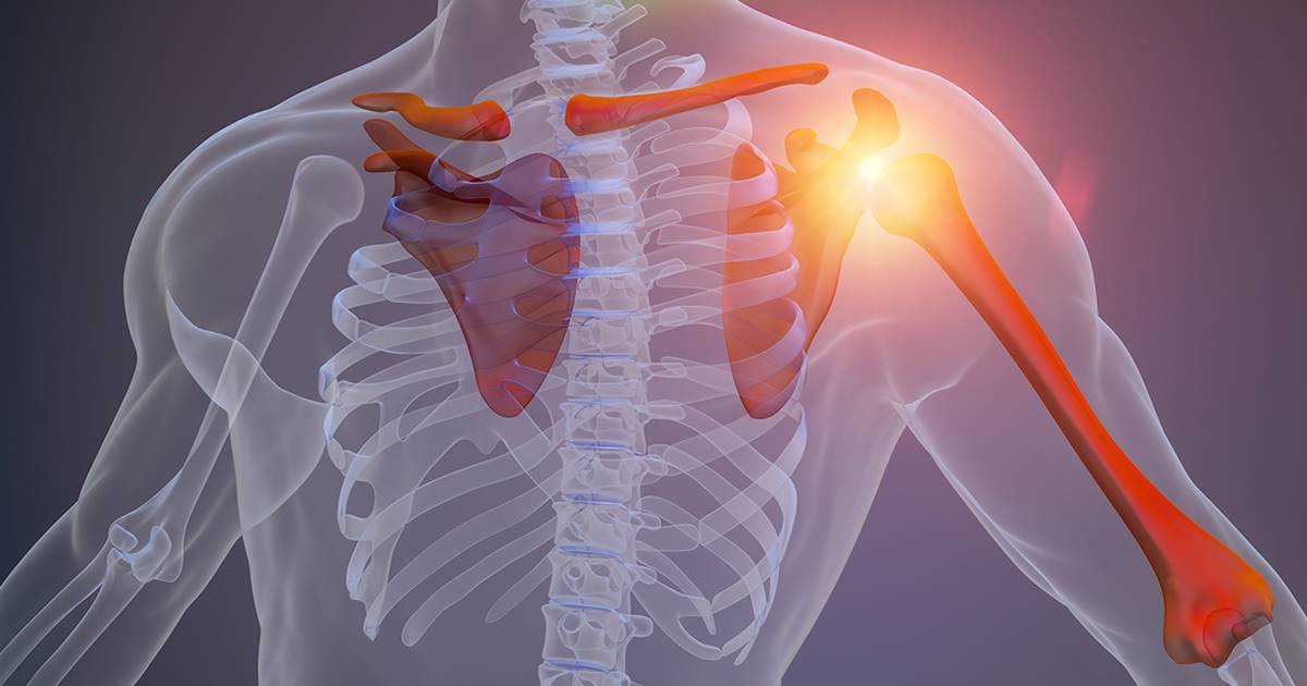 Calcificaciones ¿Qué son y cuáles son sus causas? | Mivi Salud