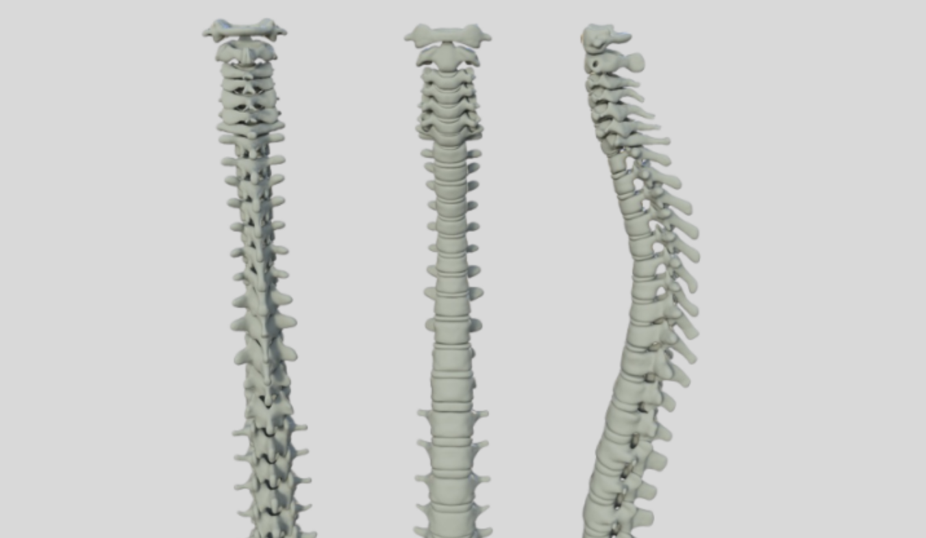 What is disc protrusion? Symptoms and treatment | Mivi Salud